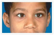 ISEC Eye Centre Myanmar |Strabismus (Squint) - ISEC Eye Centre Myanmar